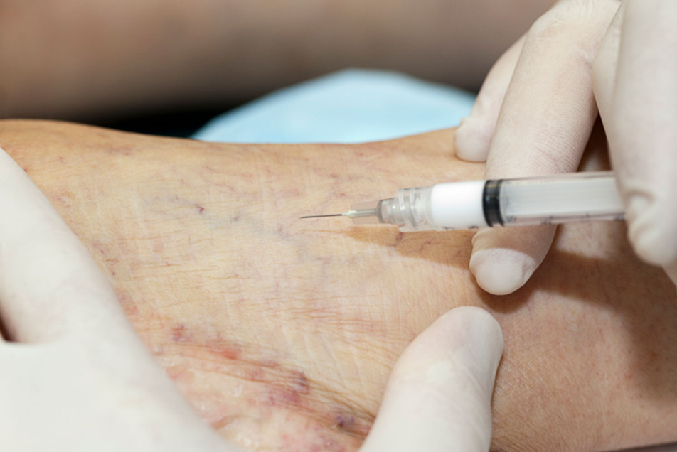 How Varicose Vein Injection Can Restore Confidence?